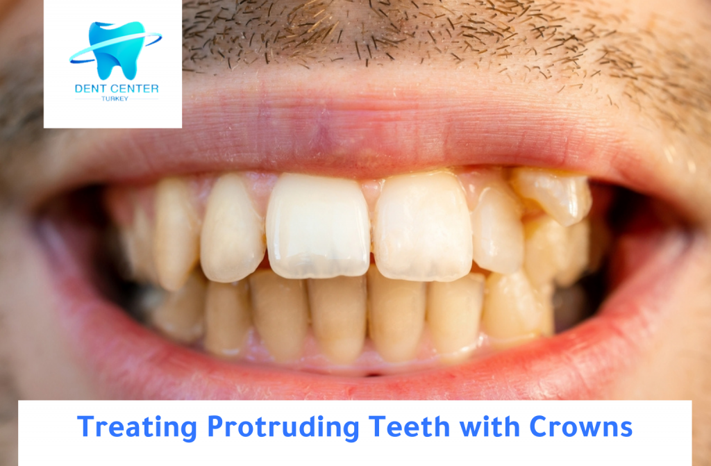 Treatment of protruding teeth with crowns - DentCenterTurkey