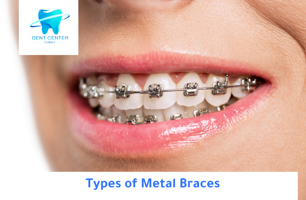 Types of Metal Braces - DentCenterTurkey