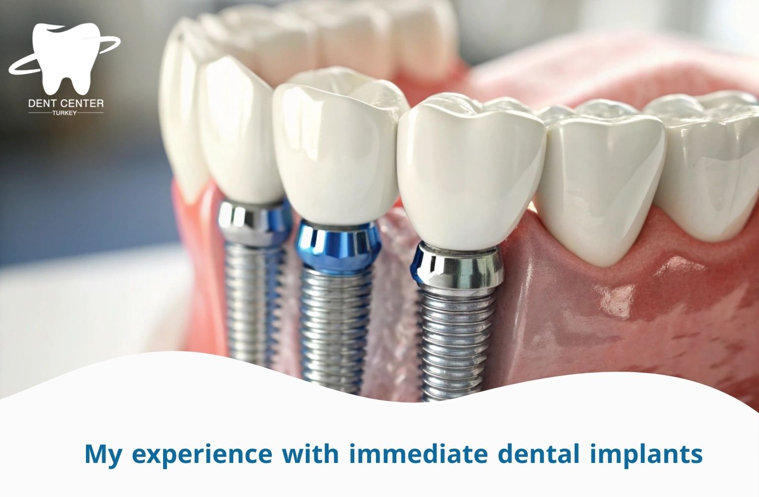 My Experience with Immediate Dental Implants - DentCenterTurkey